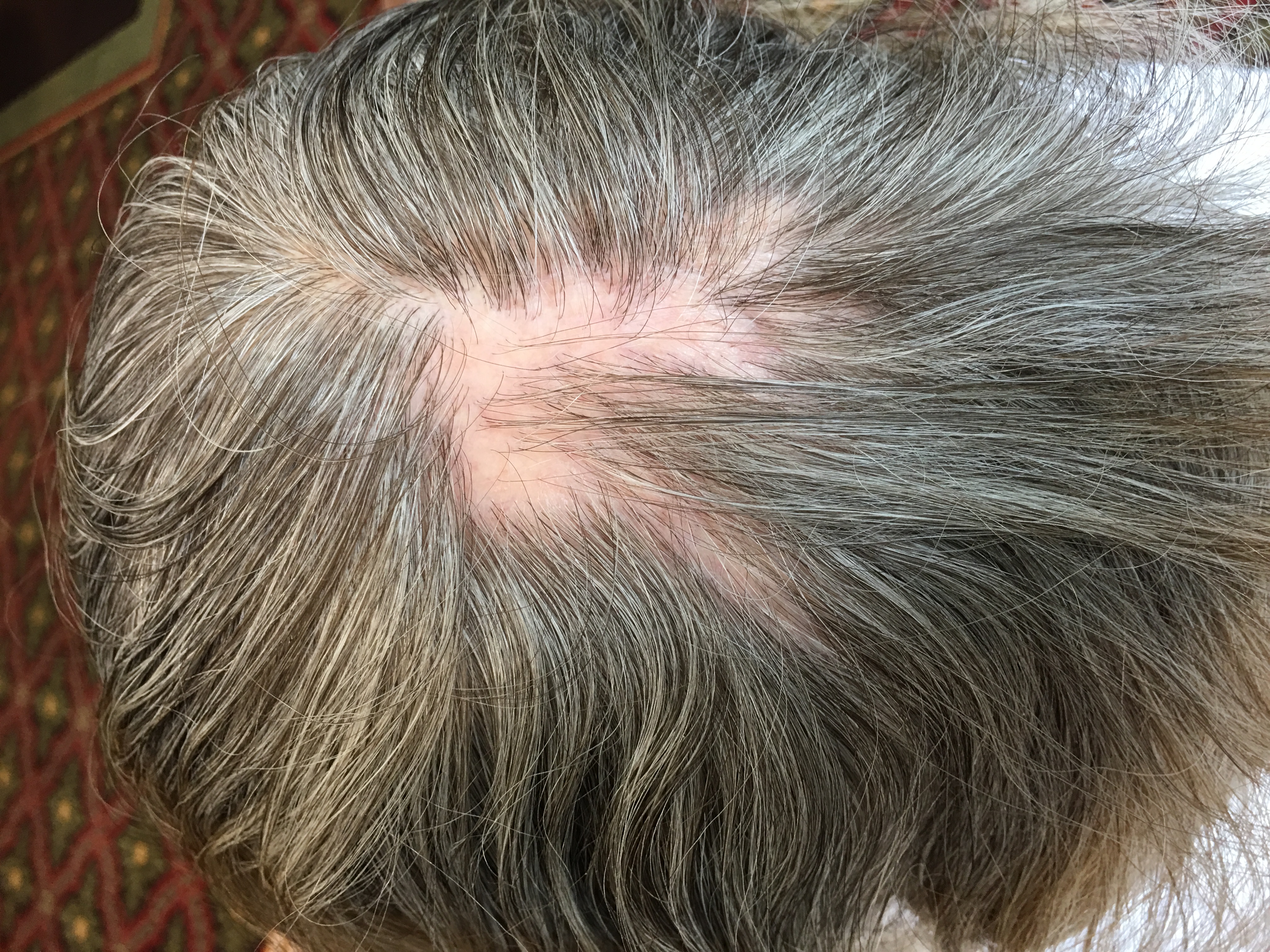 Uncover Hair Loss Causes & Solutions for Men & Women – Here's How!