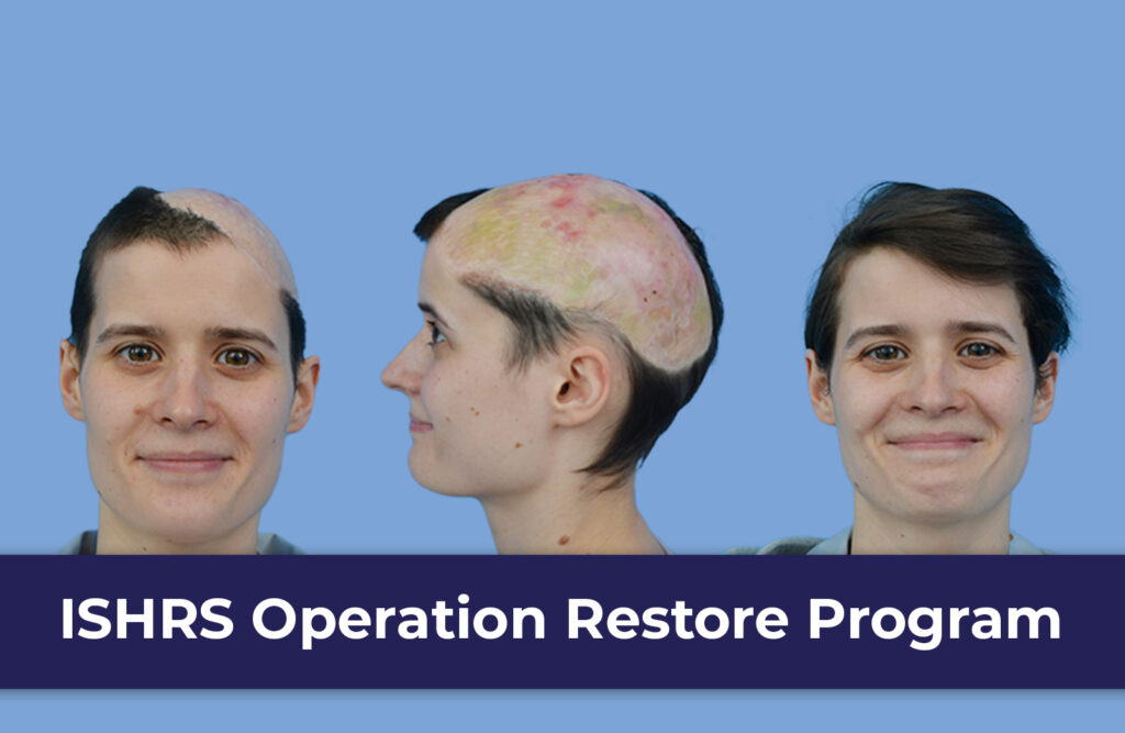 Discover the Gold Standard in Hair Restoration Surgery