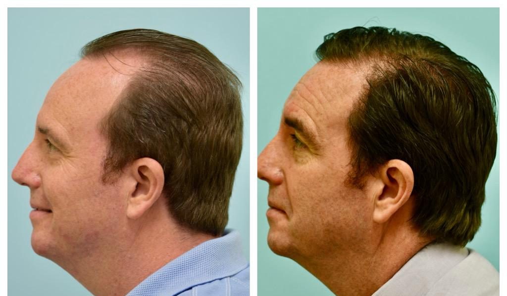 FUT Hair Transplant: Benefits, Procedure & Recovery