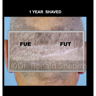FUT Hair Transplant: Benefits, Procedure & Recovery