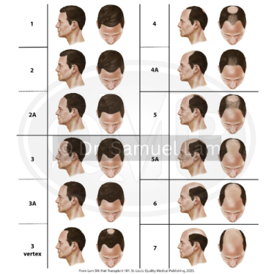 Androgenetic Alopecia: A Guide to Pattern Hair Loss - ISHRS