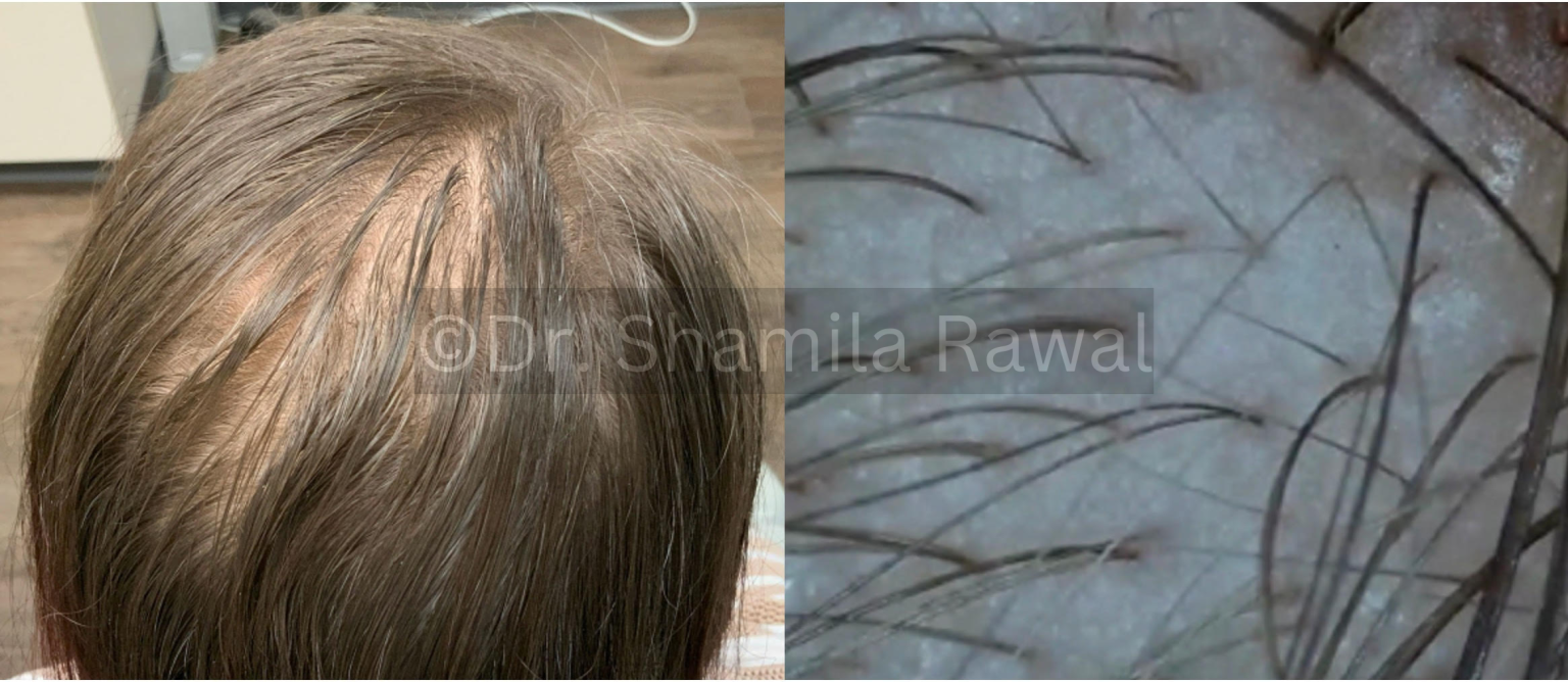 Telogen Effluvium: A Guide to Temporary Hair Loss - ISHRS