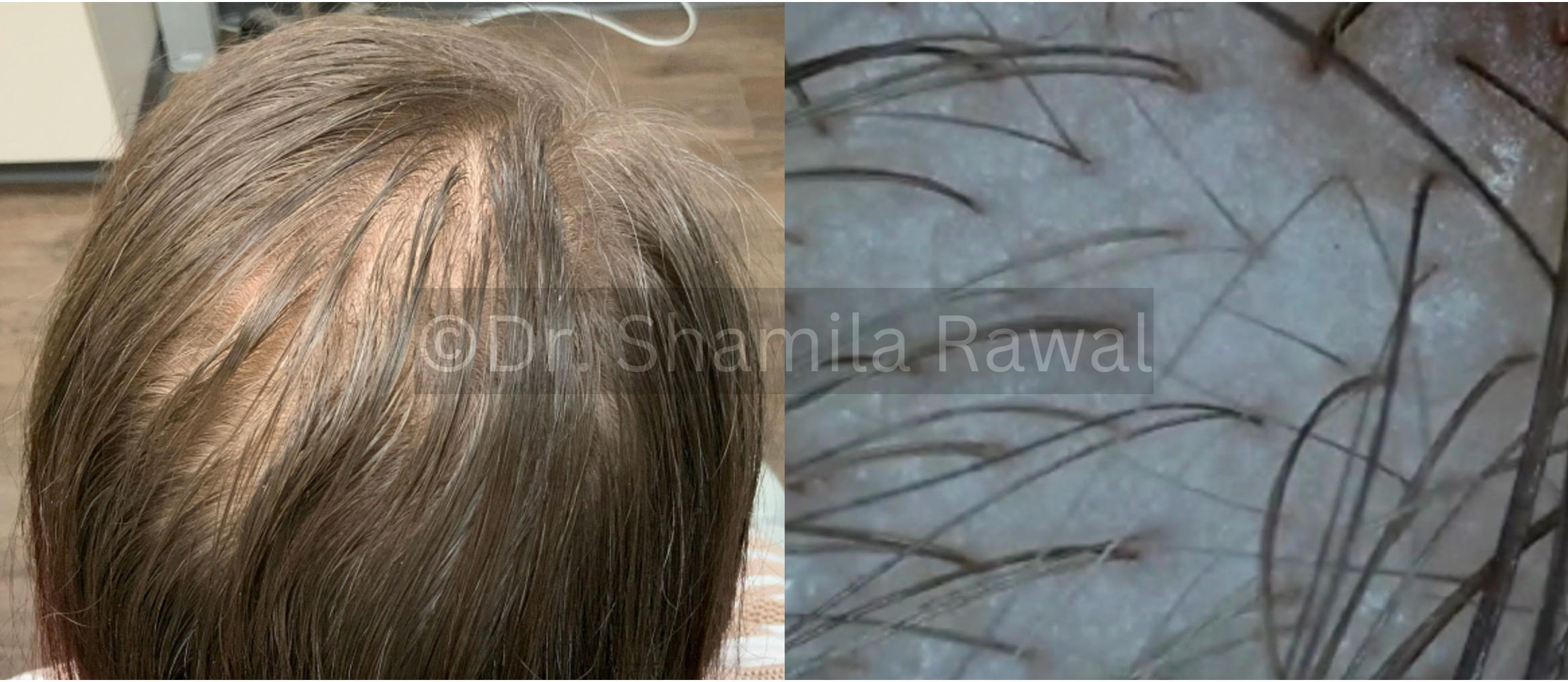 Telogen Effluvium: A Guide to Temporary Hair Loss - ISHRS