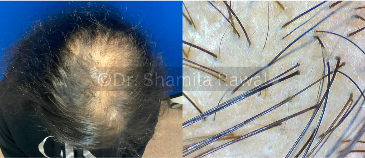 Telogen Effluvium: A Guide to Temporary Hair Loss - ISHRS