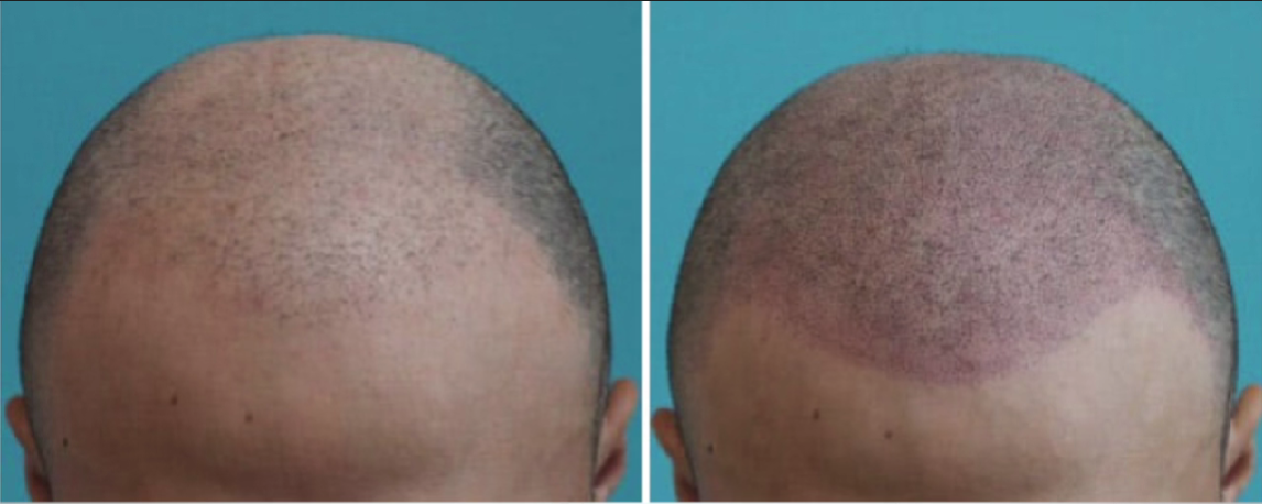 Scalp Micropigmentation (SMP): All You Need to Know - ISHRS
