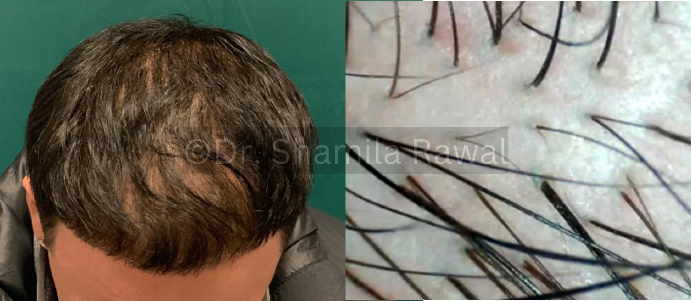 Telogen Effluvium: A Guide to Temporary Hair Loss - ISHRS