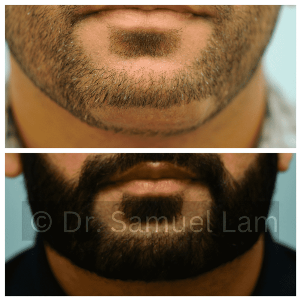 Everything You Need to Know About a Beard Transplant